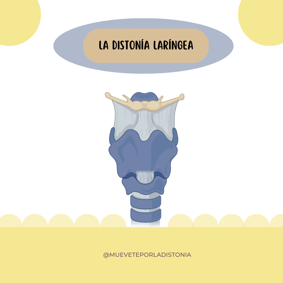 La distonía laríngea - Aludmedystonia